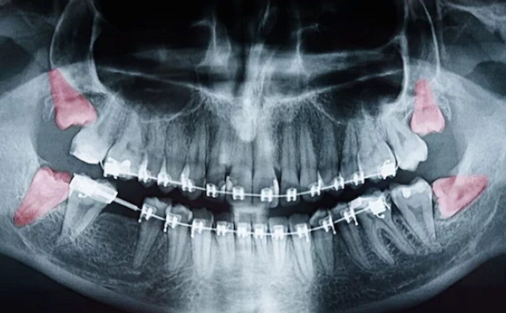 Average Number Of Teeth By Age OC Dental Center